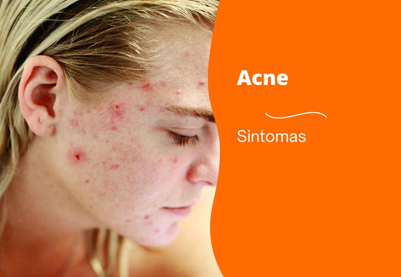 Acne, saiba mais e informe-se - Blog Nature Center